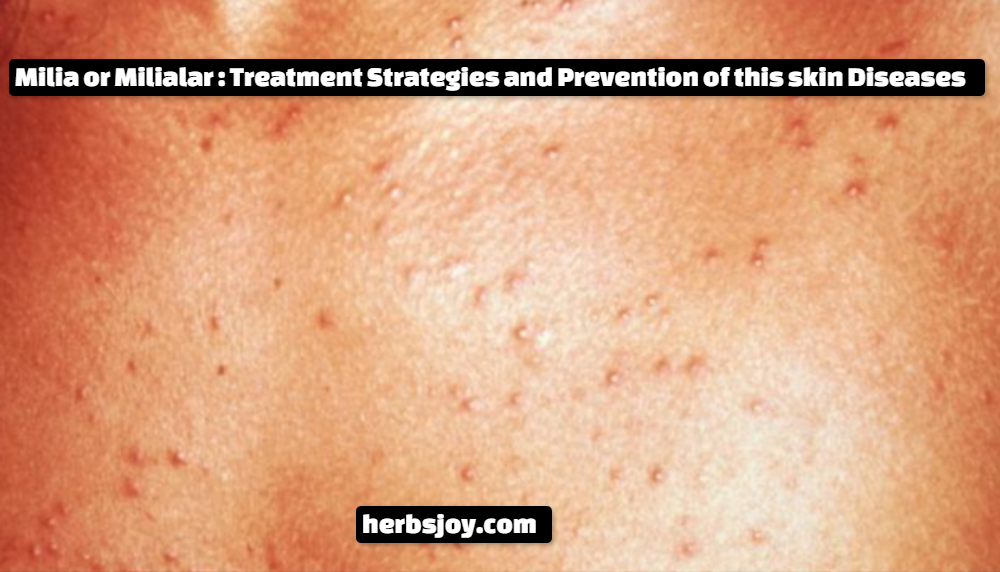 Milia or Milialar : Treatment Strategies and Prevention of this skin ...
